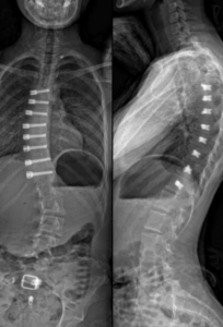 Tether - Pediatric Scoliosis